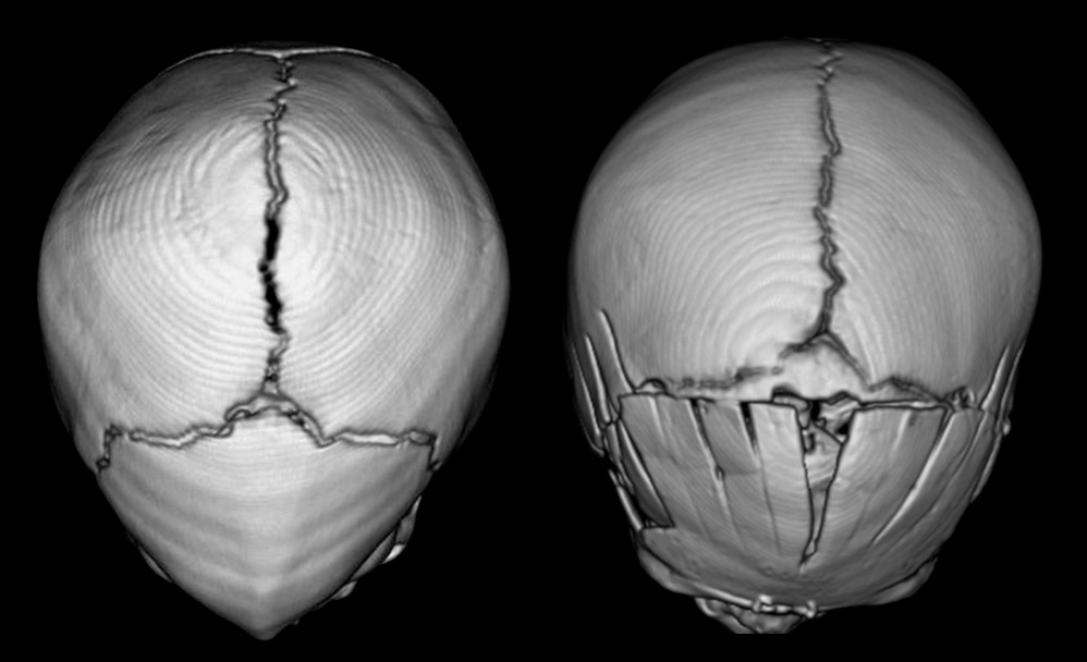 Trigonocefalia - Gabriel Mufarrej