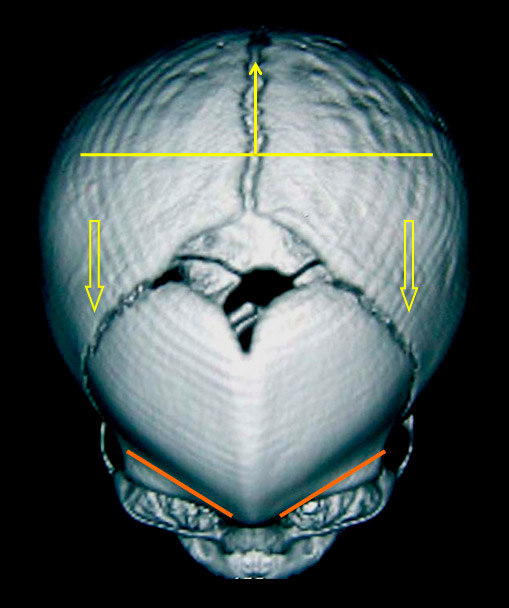 Trigonocefalia - Gabriel Mufarrej